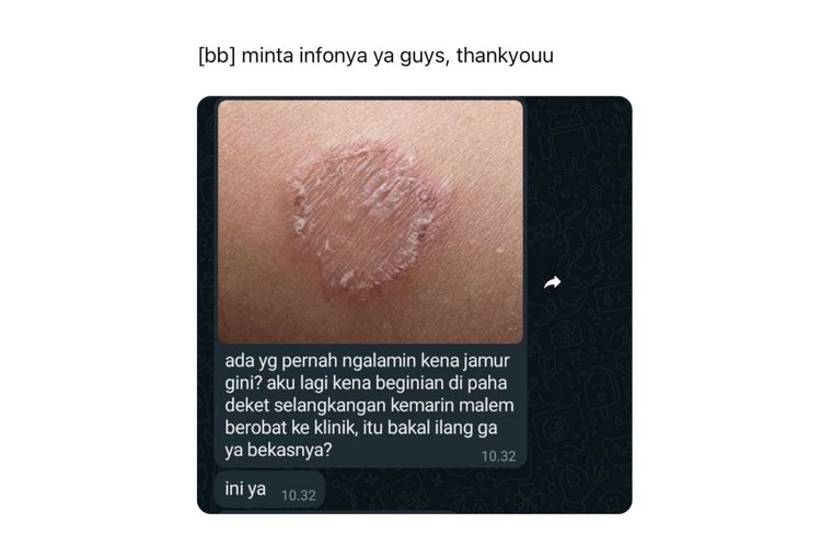 Ringworm pada Kulit: Pengertian, Pencegahan, dan Pengobatan
